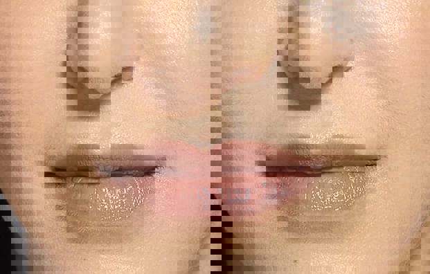 Real Results of MaiLi Hyaluronic Acid Fillers - MaiLi